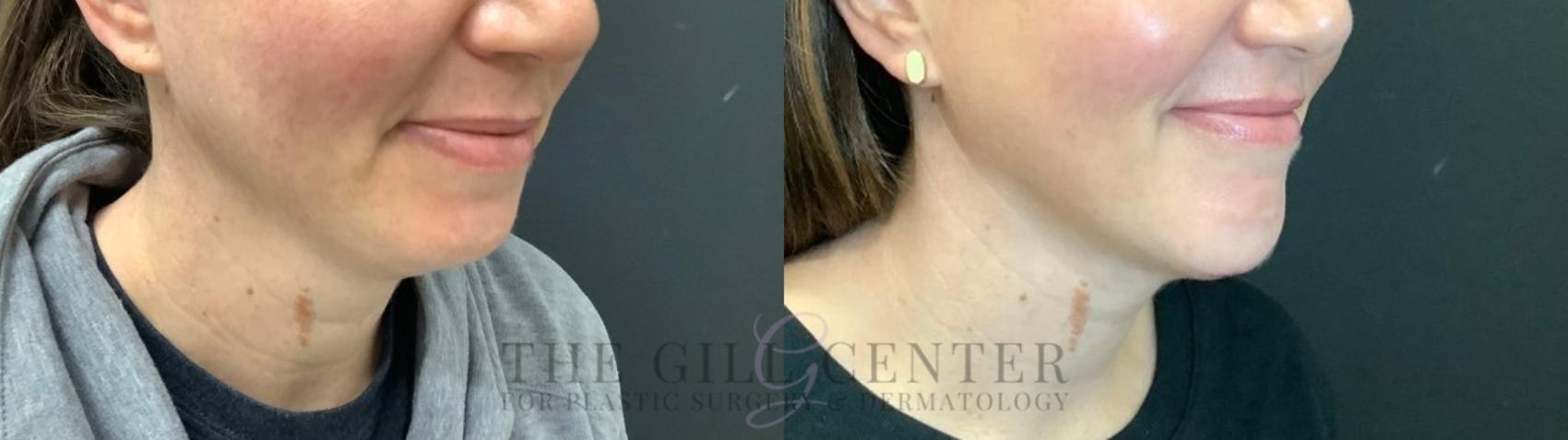 Chin Augmentation Before & After Photos Patient 512 | The Woodlands, TX ...
