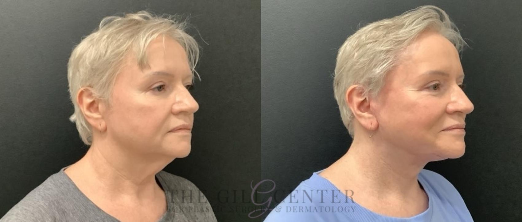Face & Neck Lift Before & After Photos Patient 679 | The Woodlands, TX ...